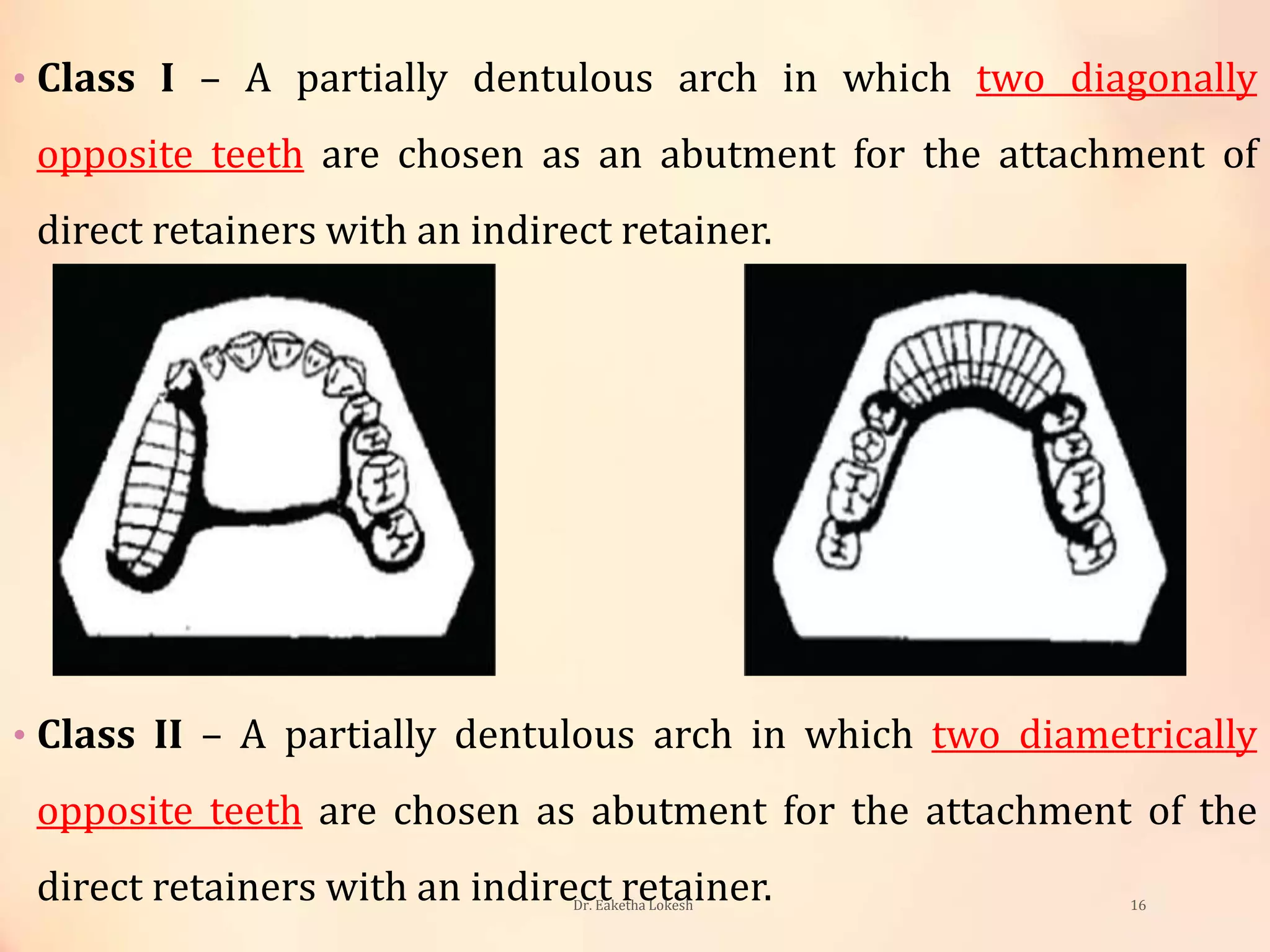 Classification systems for partially edentulous arches | PPTX