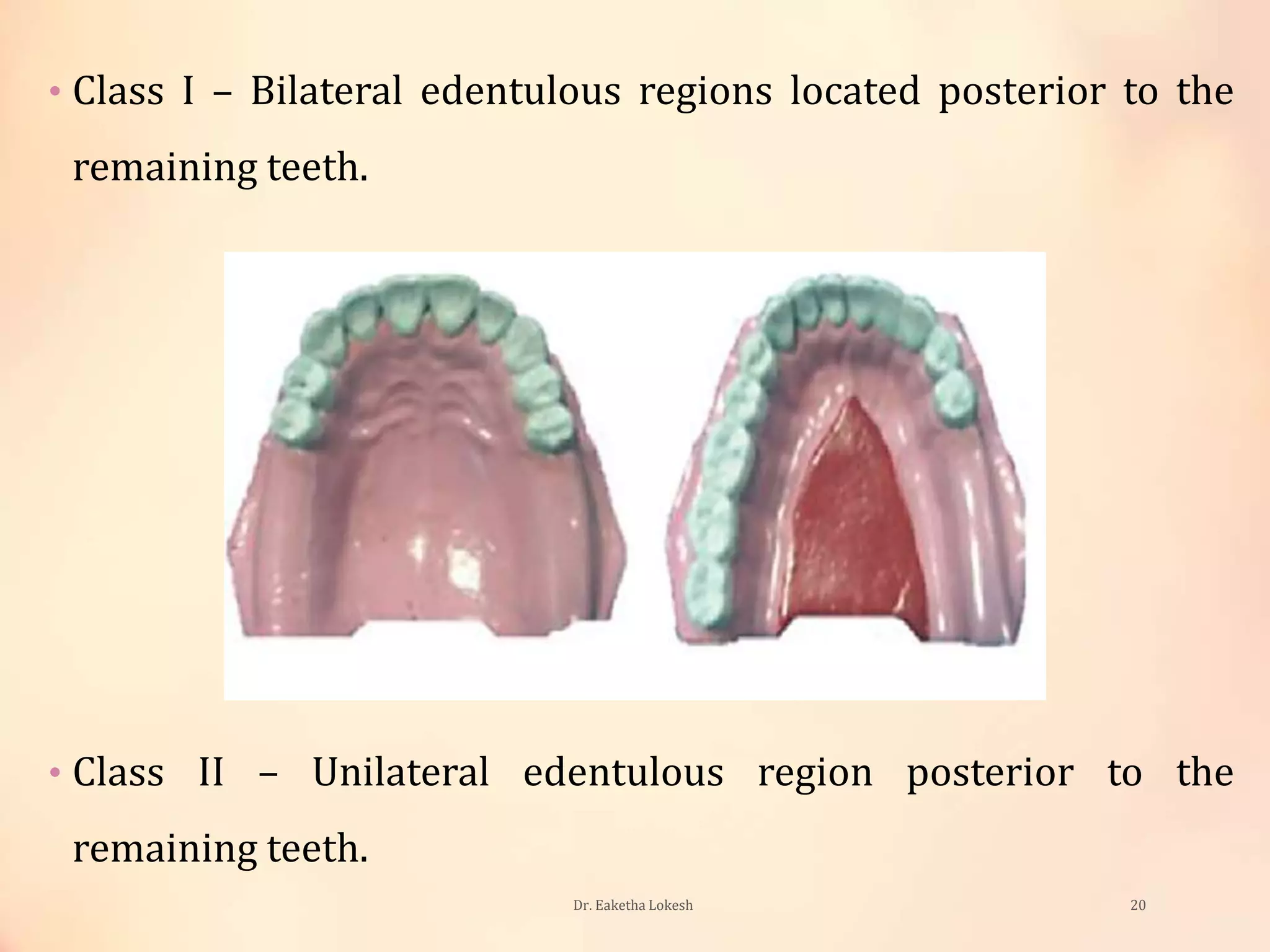 Classification systems for partially edentulous arches | PPTX