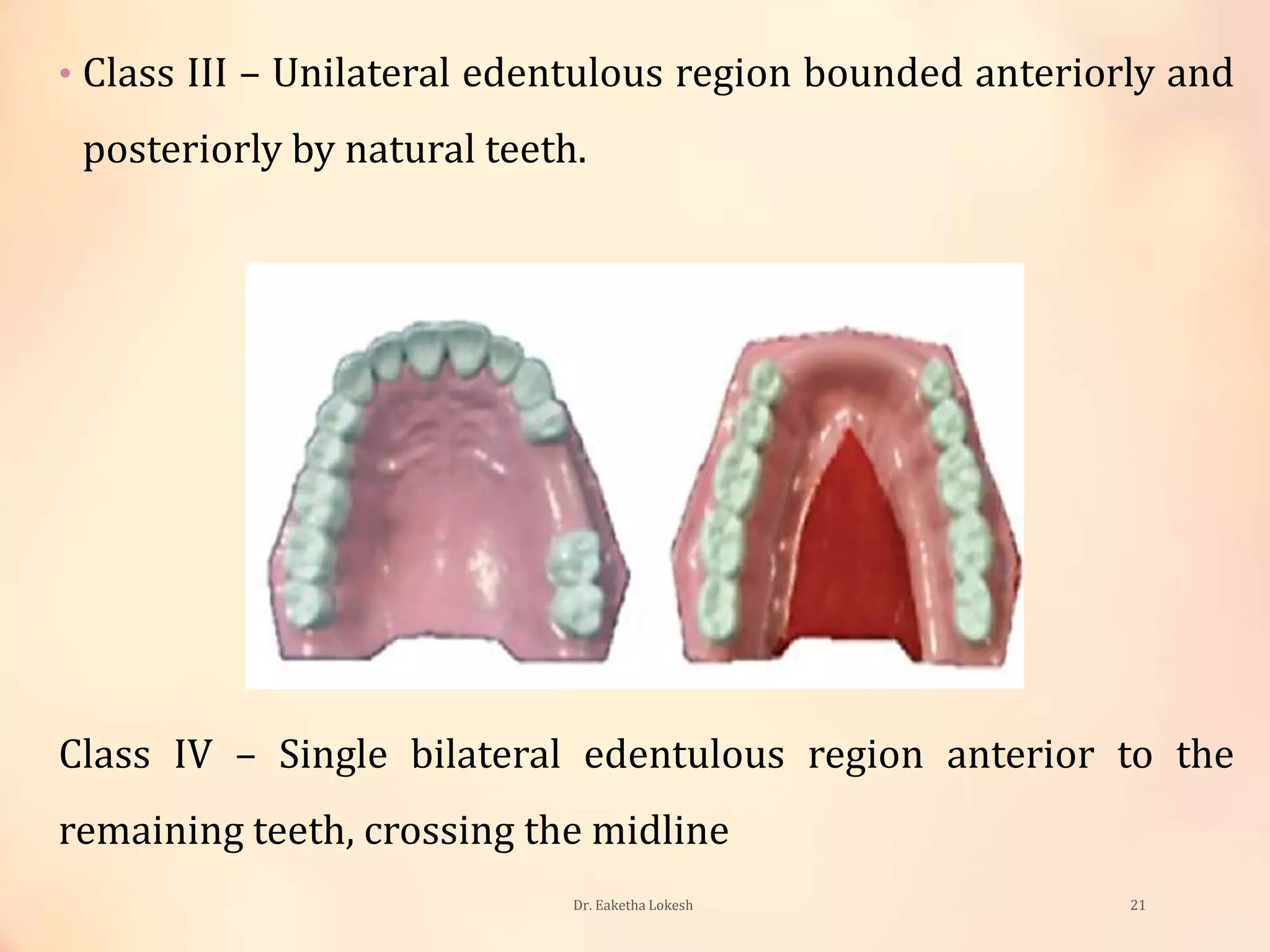 Classification systems for partially edentulous arches | PPTX