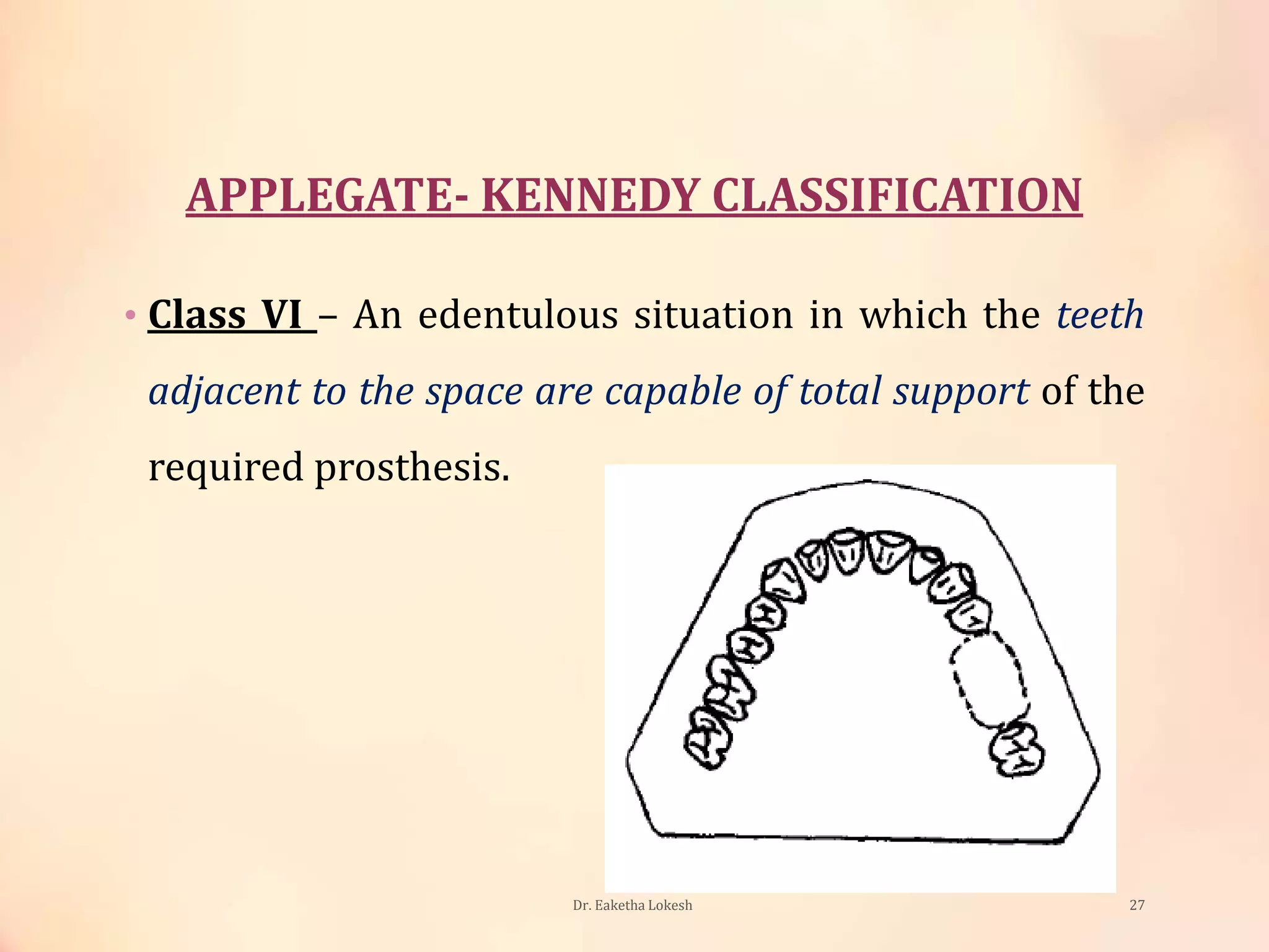 Classification systems for partially edentulous arches | PPTX