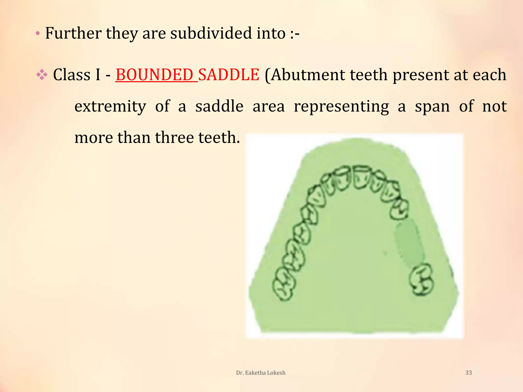 Classification systems for partially edentulous arches | PPTX