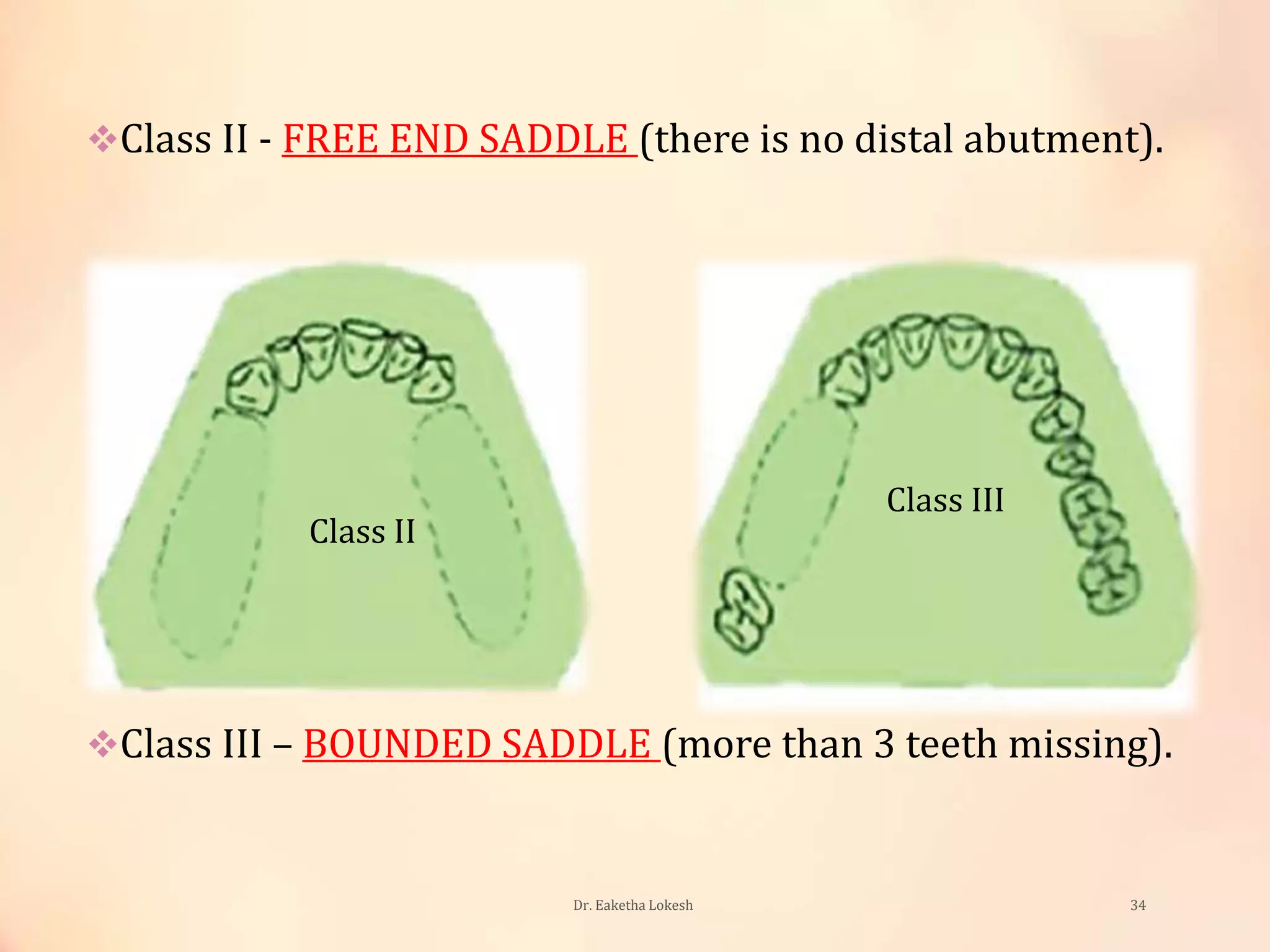 Classification systems for partially edentulous arches | PPTX