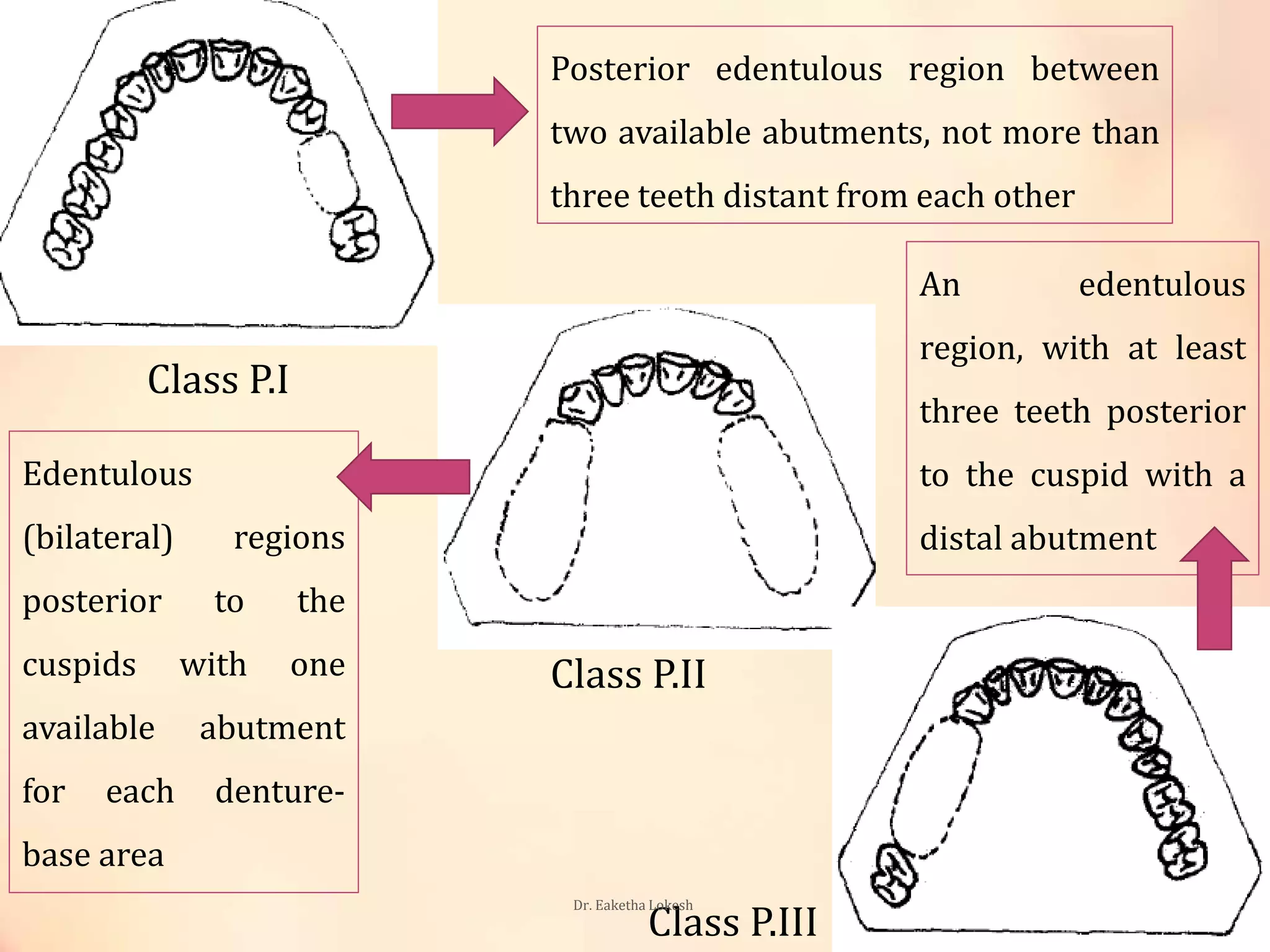 Classification systems for partially edentulous arches | PPTX
