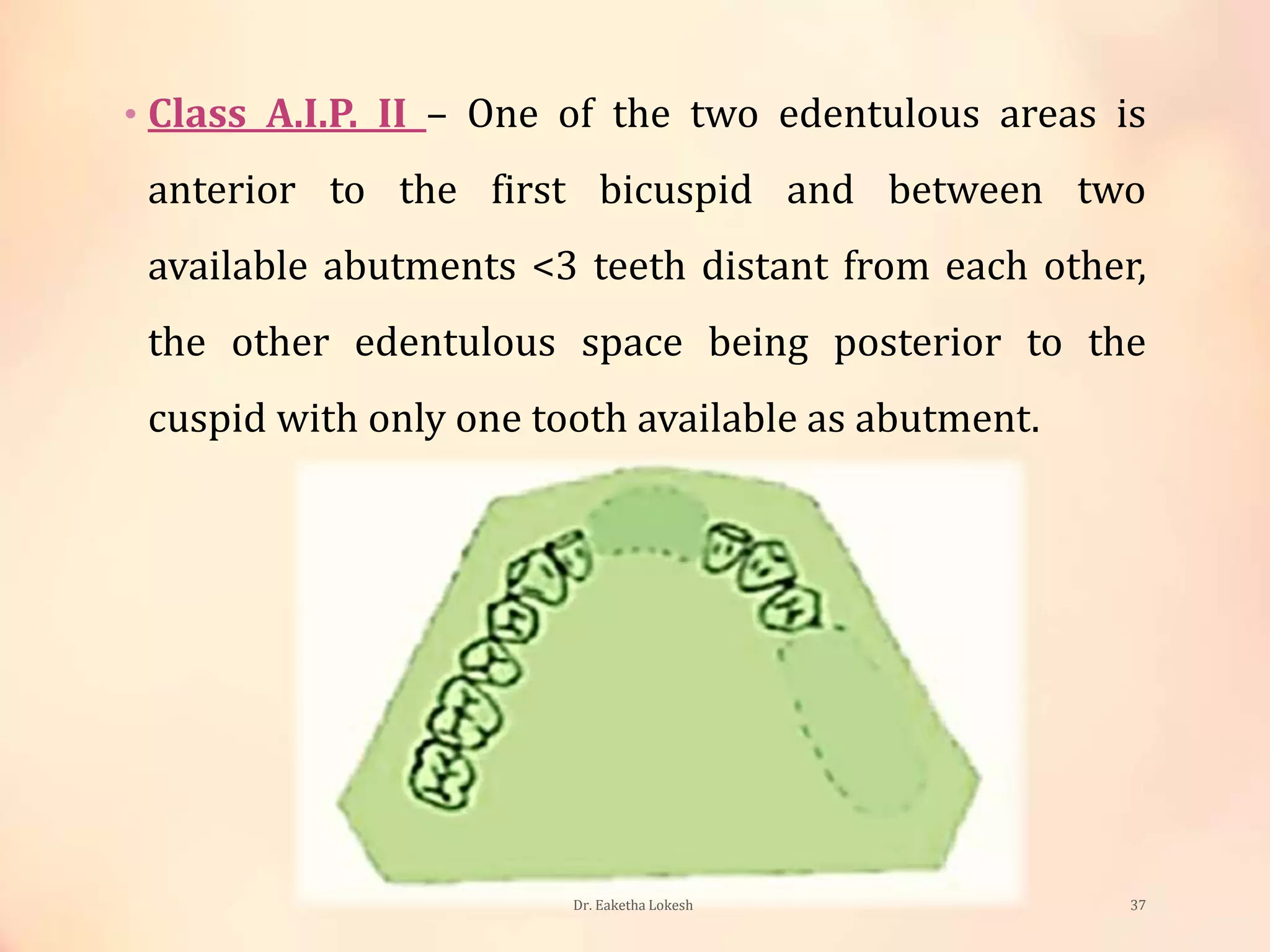 Classification systems for partially edentulous arches | PPTX