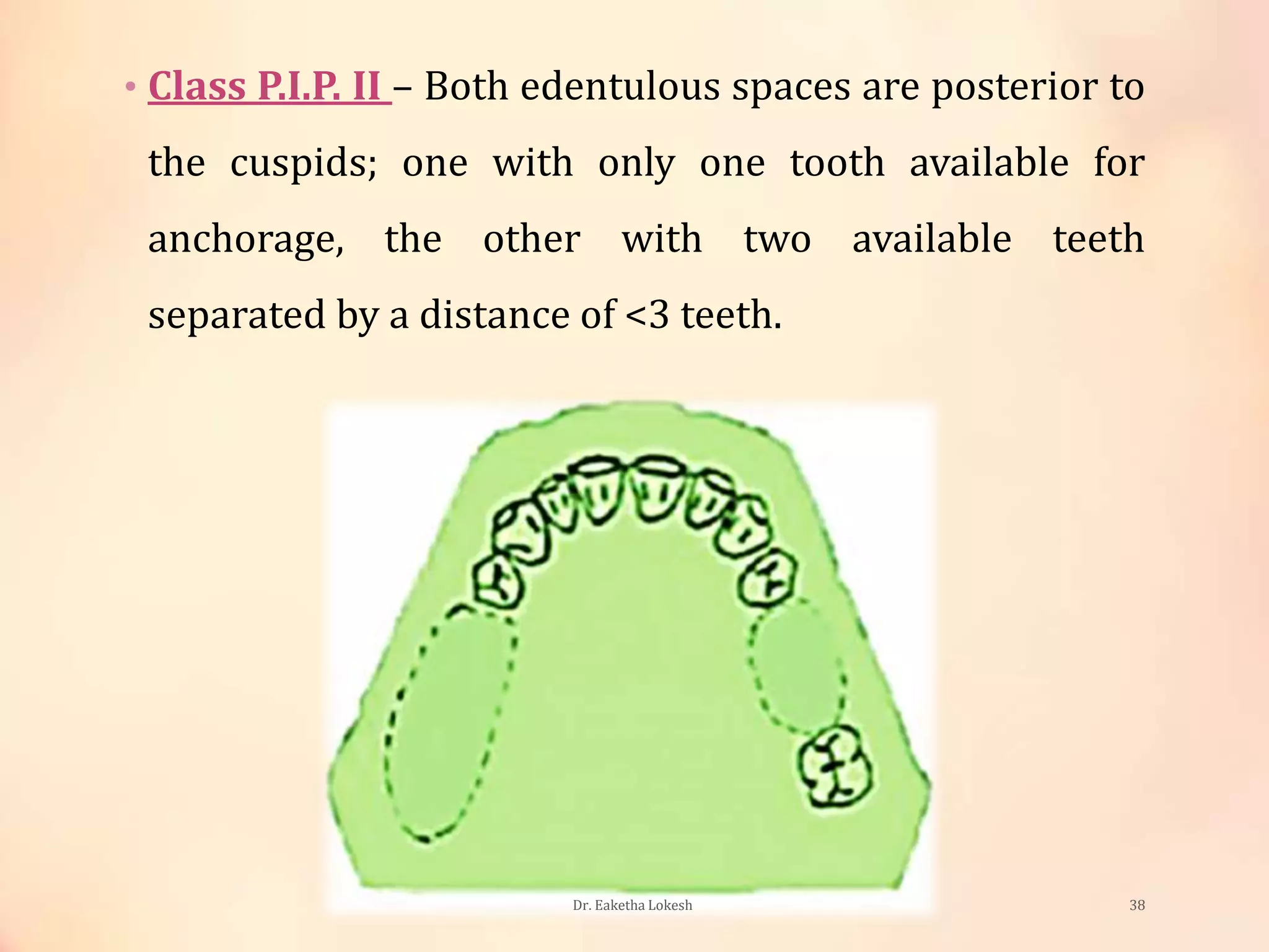 Classification systems for partially edentulous arches | PPTX
