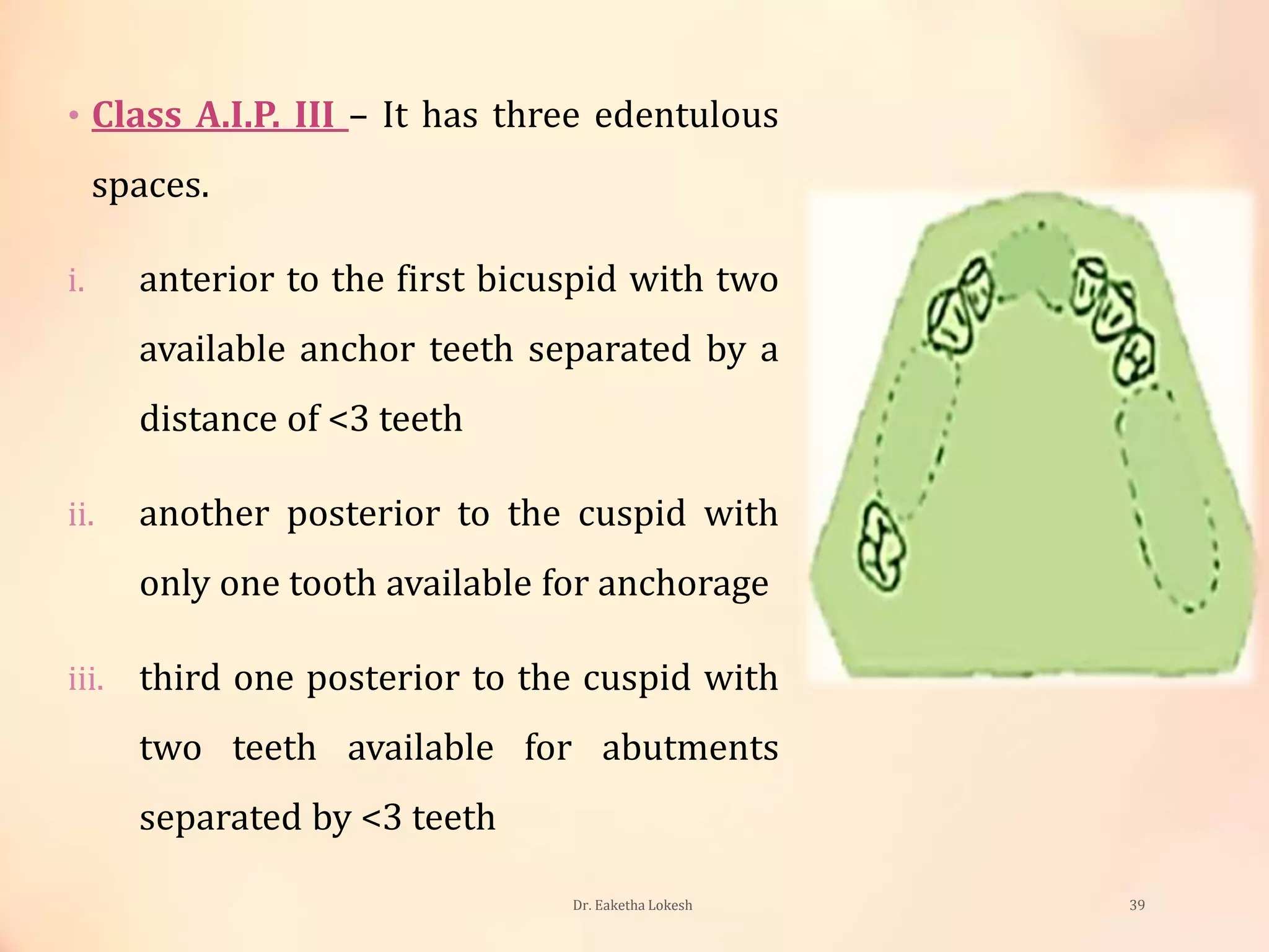 Classification systems for partially edentulous arches | PPTX