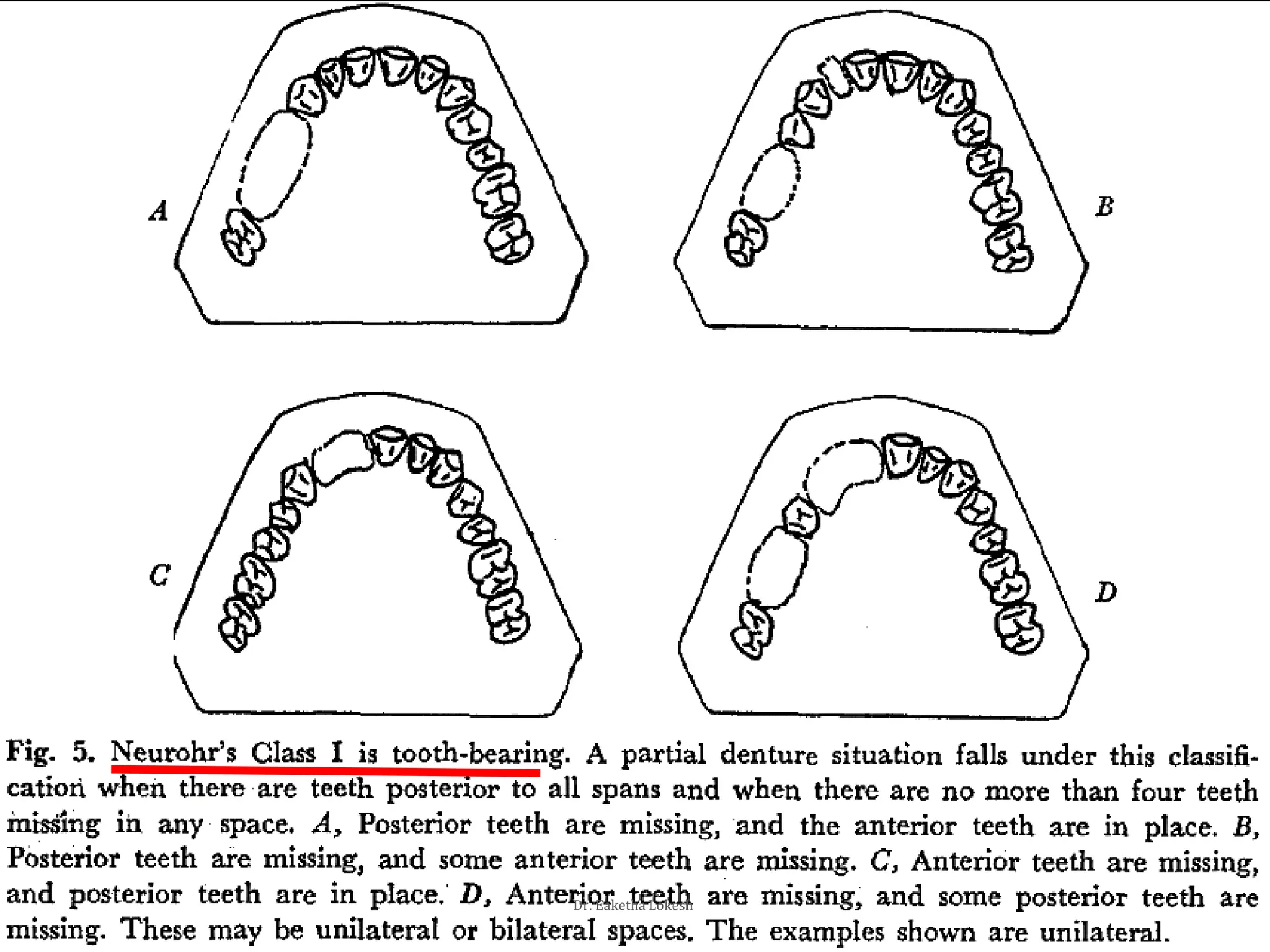Classification systems for partially edentulous arches | PPTX