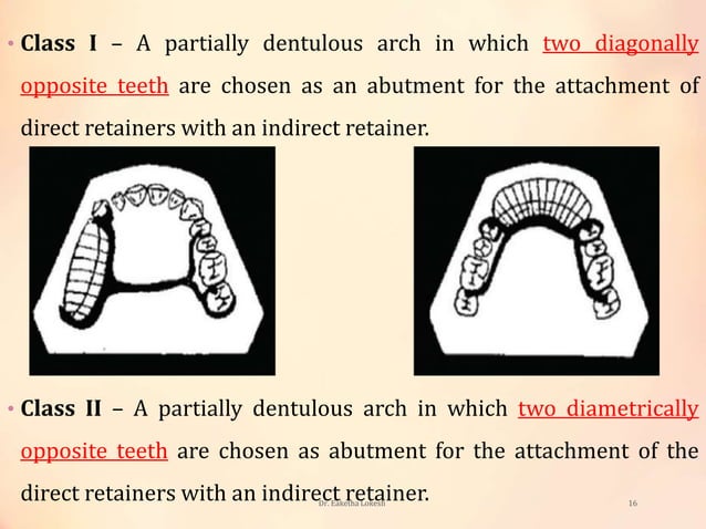 Classification systems for partially edentulous arches | PPTX | Dental ...
