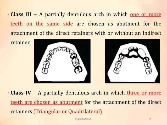 Classification systems for partially edentulous arches | PPTX | Dental ...