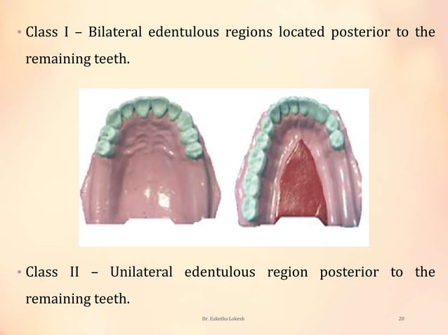 Classification systems for partially edentulous arches | PPTX | Dental ...