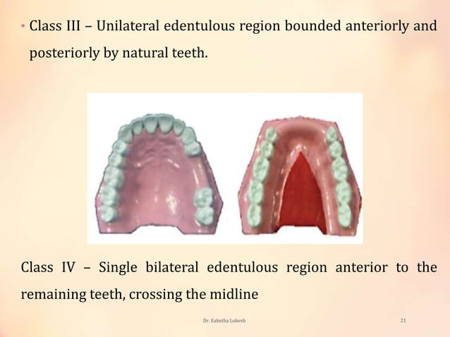 Classification systems for partially edentulous arches | PPTX | Dental ...