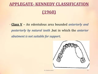 Classification systems for partially edentulous arches | PPTX