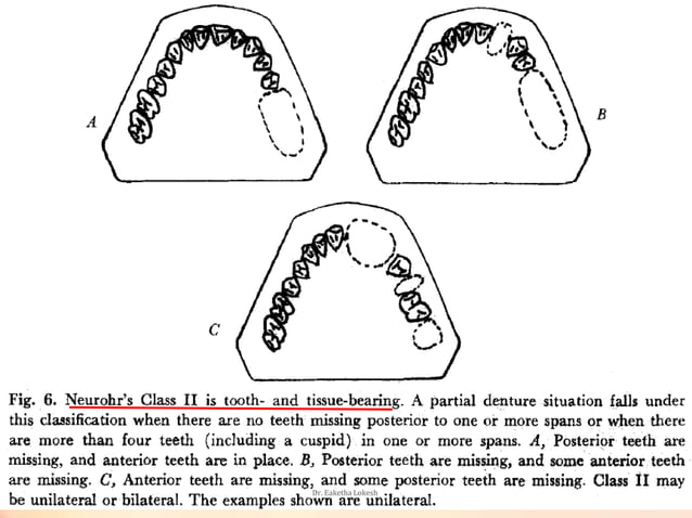 Classification systems for partially edentulous arches | PPTX | Dental ...