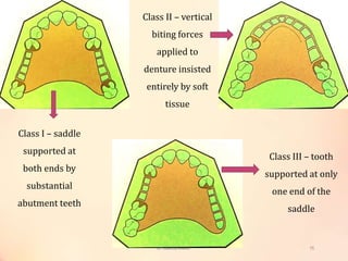 Classification systems for partially edentulous arches | PPTX