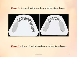 Classification systems for partially edentulous arches | PPTX