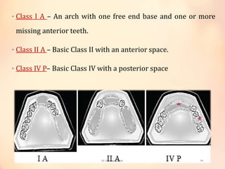 Classification systems for partially edentulous arches | PPTX