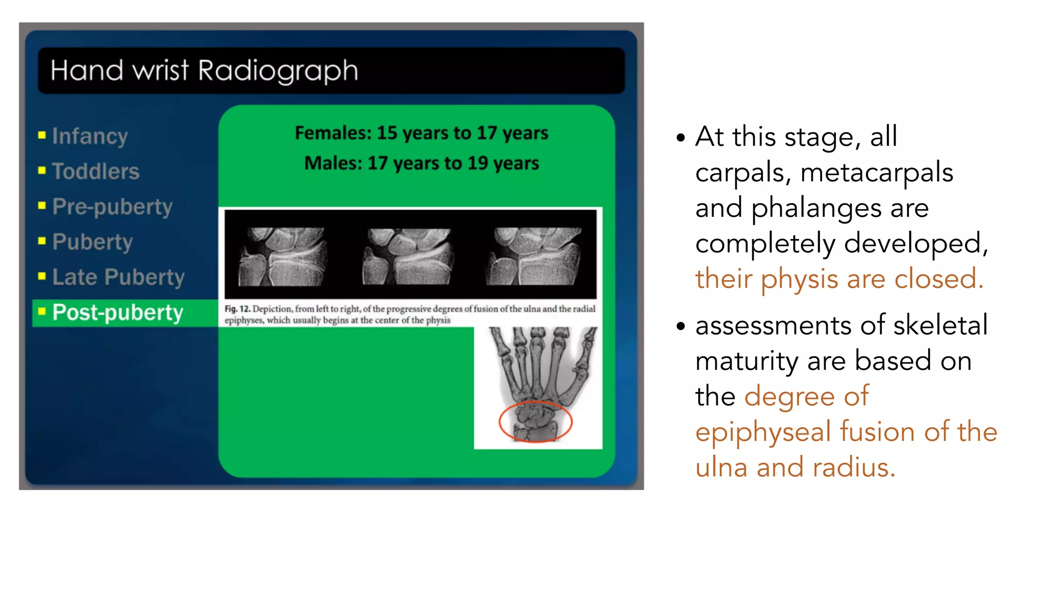 BONE AGE ESTIMATION | PDF