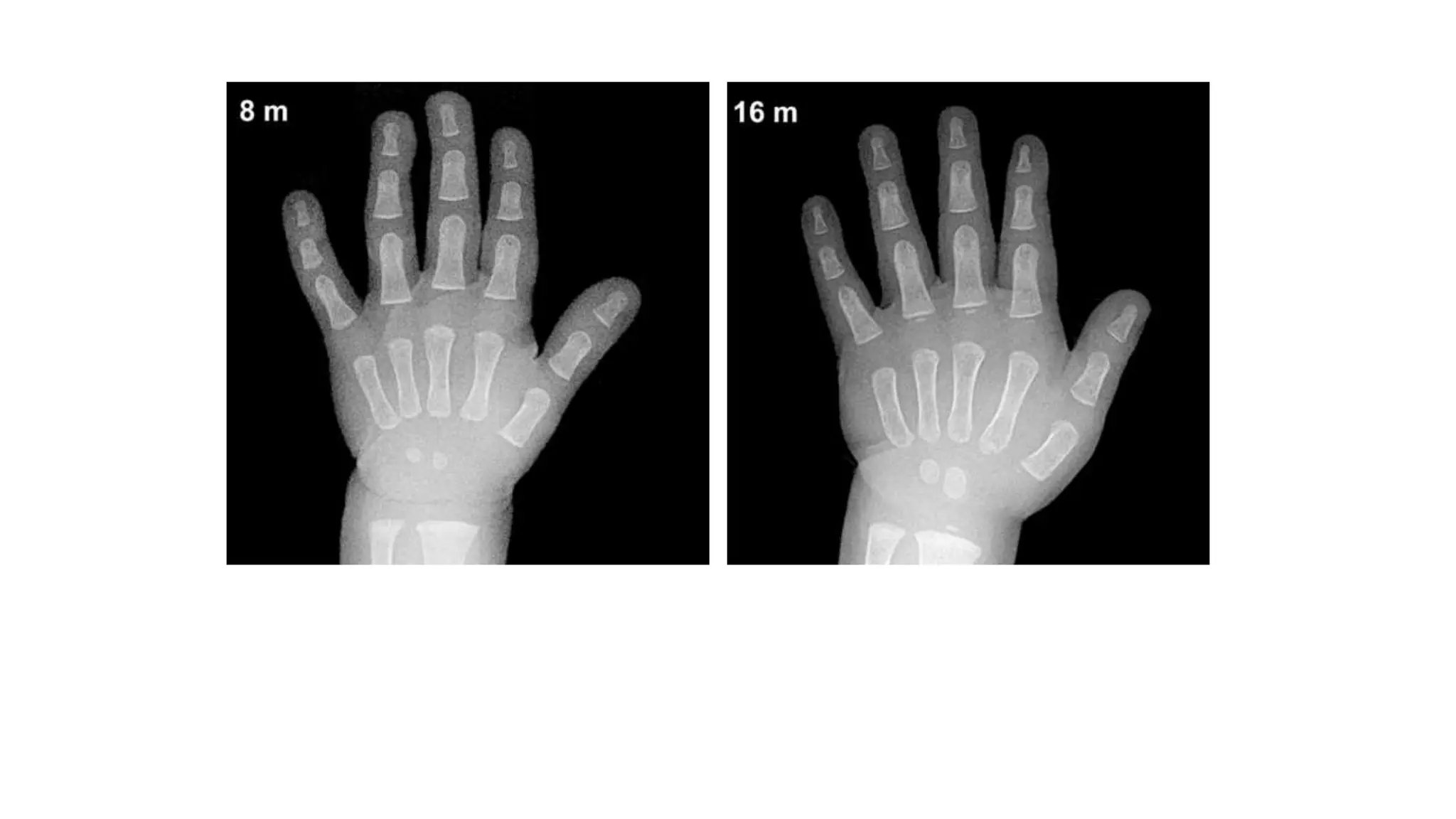 BONE AGE ESTIMATION | PDF