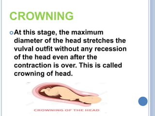 presentation on second stage of labor | PPTX