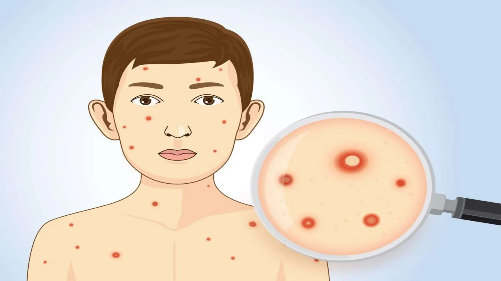 chicken pox and small pox management.pptx