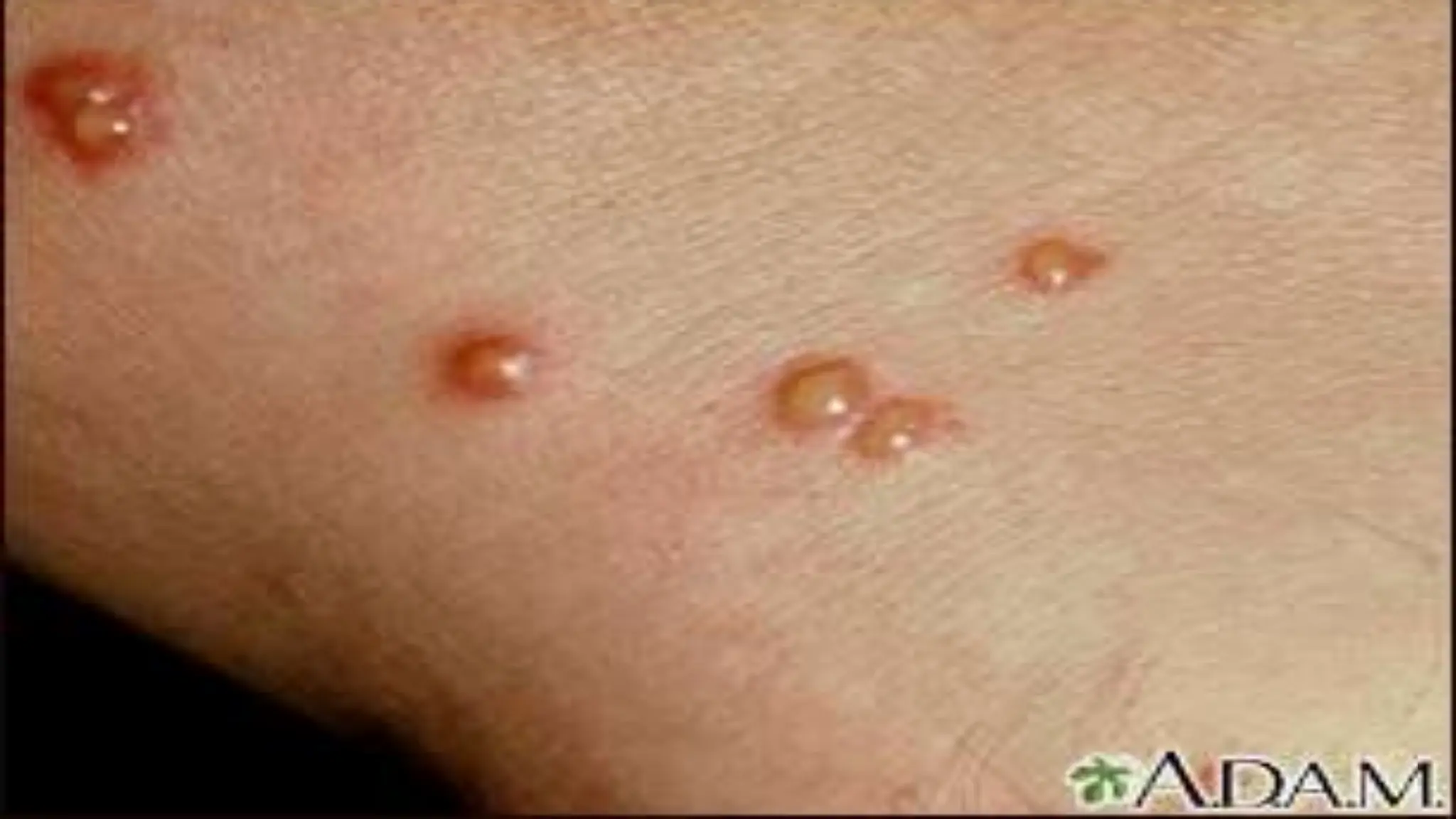 chicken pox and small pox management.pptx