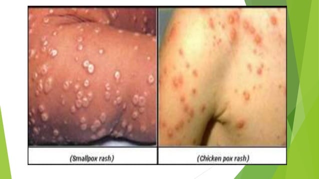 chicken pox and small pox management.pptx