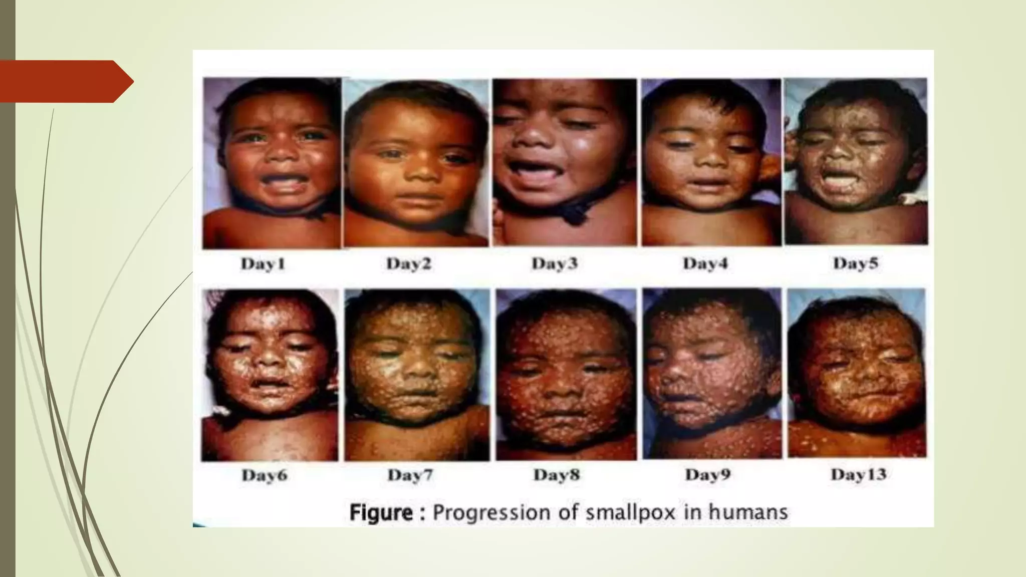 Presentation on smallpox | PPTX