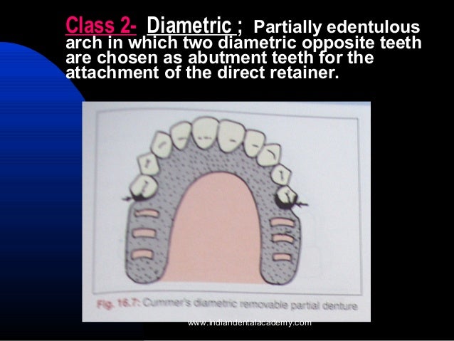 Classification of rpd / dentist laboratory