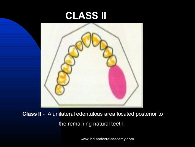 Classification of rpd / dentist laboratory