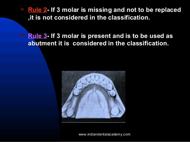 Classification of rpd / dentist laboratory
