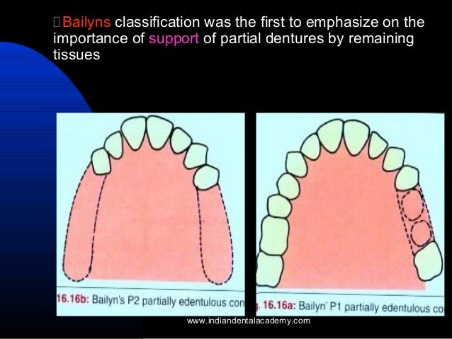 Classification of rpd / dentist laboratory