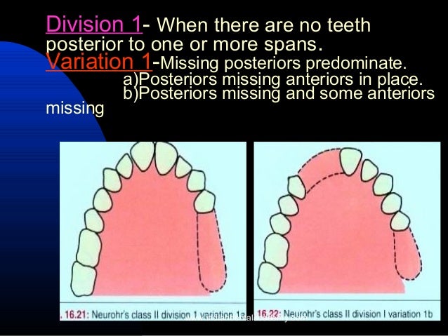 Classification of rpd / dentist laboratory