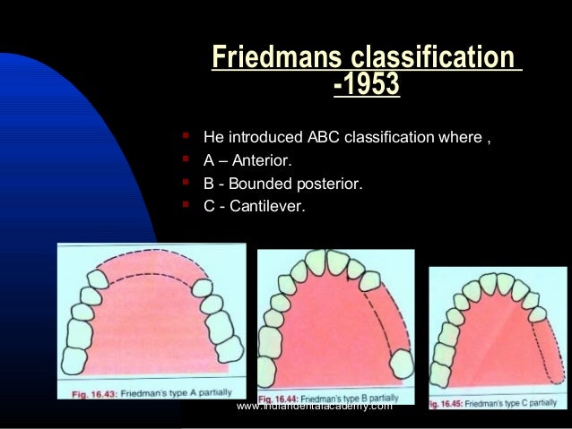 Classification of rpd / dentist laboratory