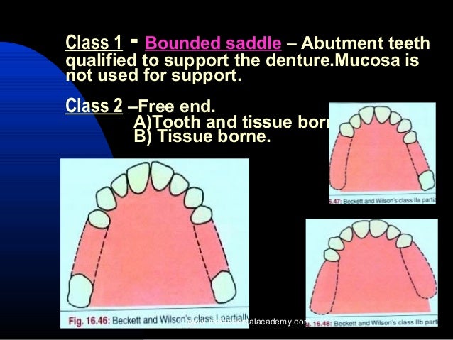 Classification of rpd / dentist laboratory