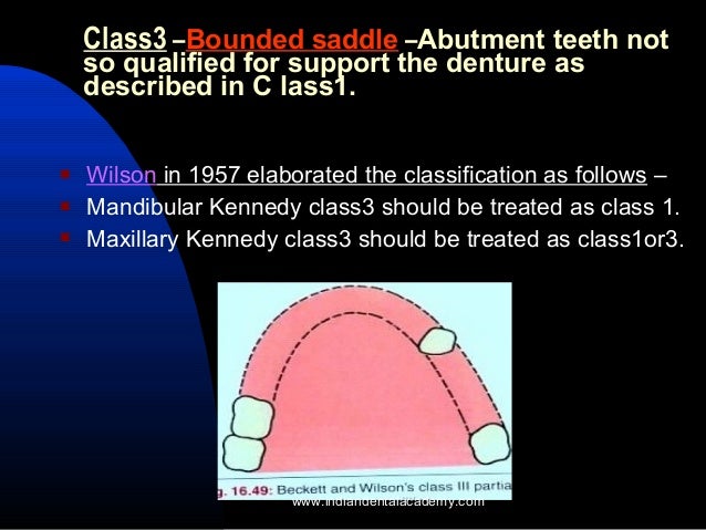 Classification of rpd / dentist laboratory