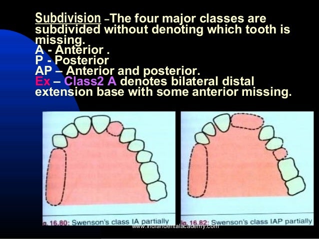Classification of rpd / dentist laboratory