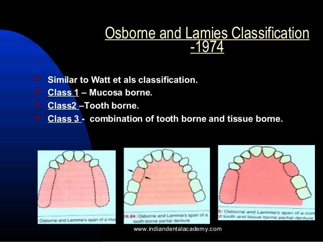 Classification of rpd / dentist laboratory