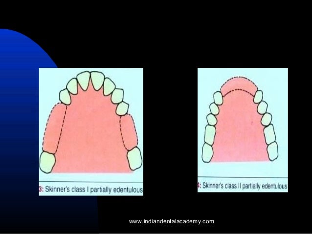 Class rpd 1final/certified fixed orthodontic courses by Indian dental…