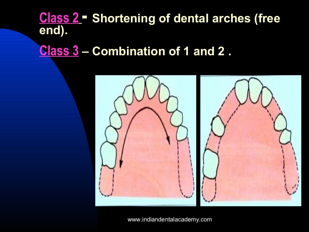 classification system for partially edentulous arches / dental implan…