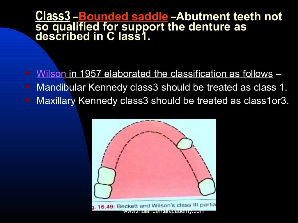classification system for partially edentulous arches / dental implan…