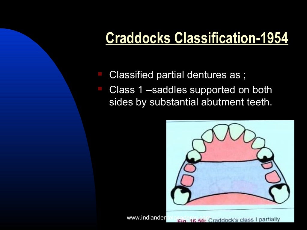 classification system for partially edentulous arches / dental implan…
