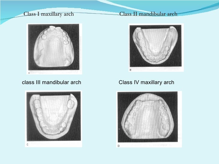 Classsification of rpd