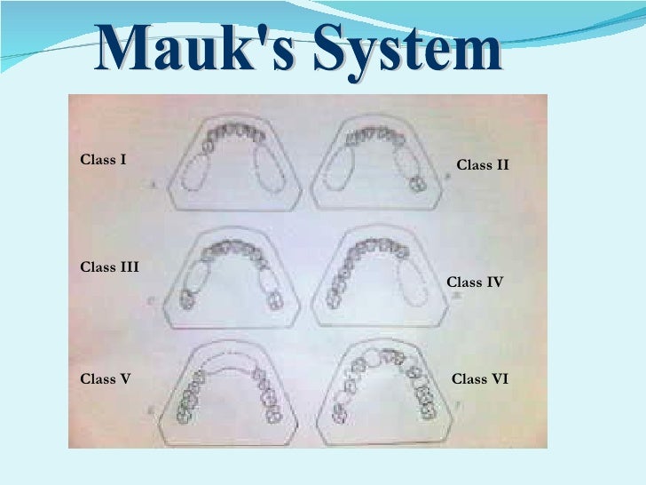 Classsification of rpd