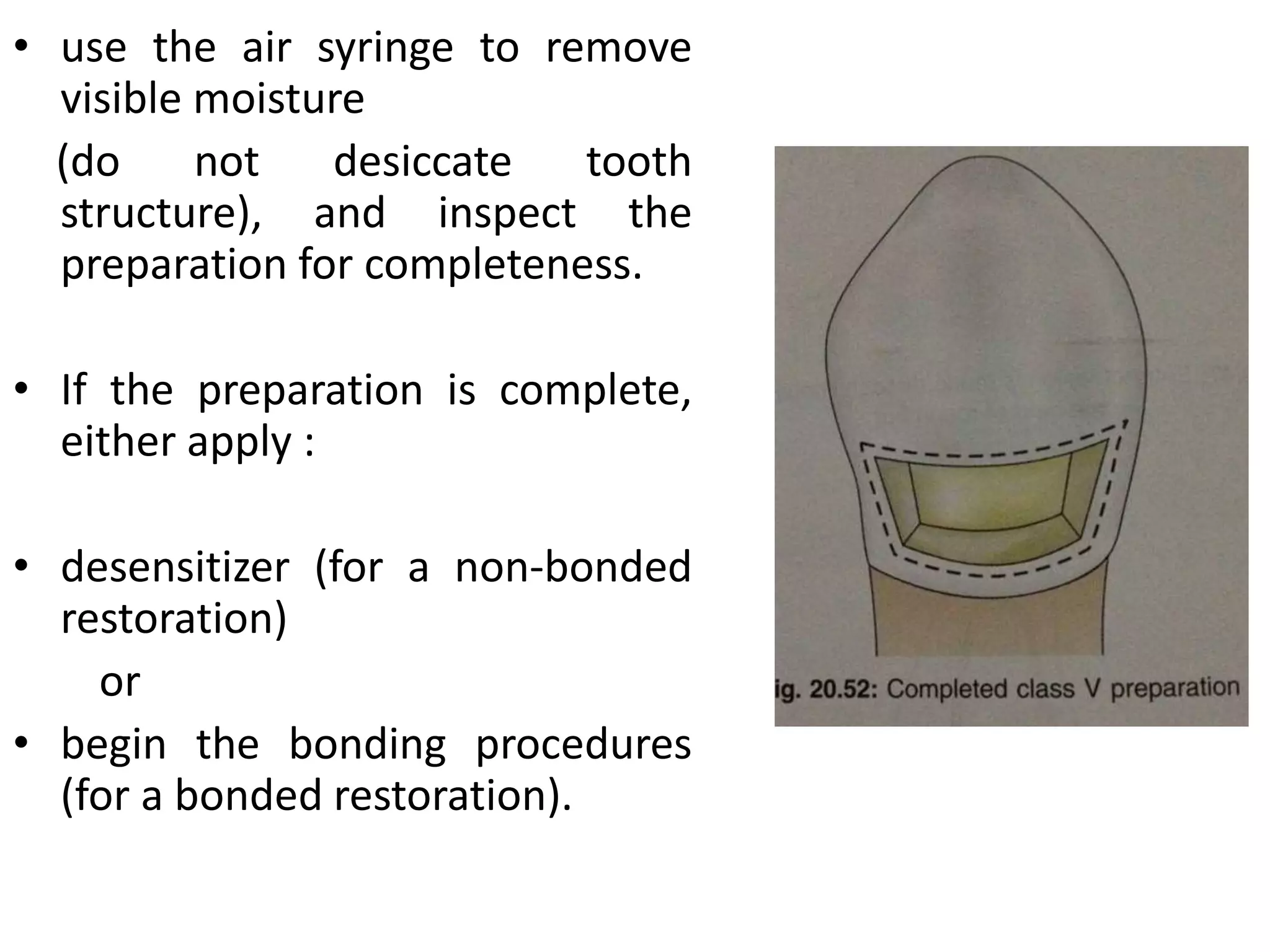 Class V and VI amalgam cavity preparations | PPTX