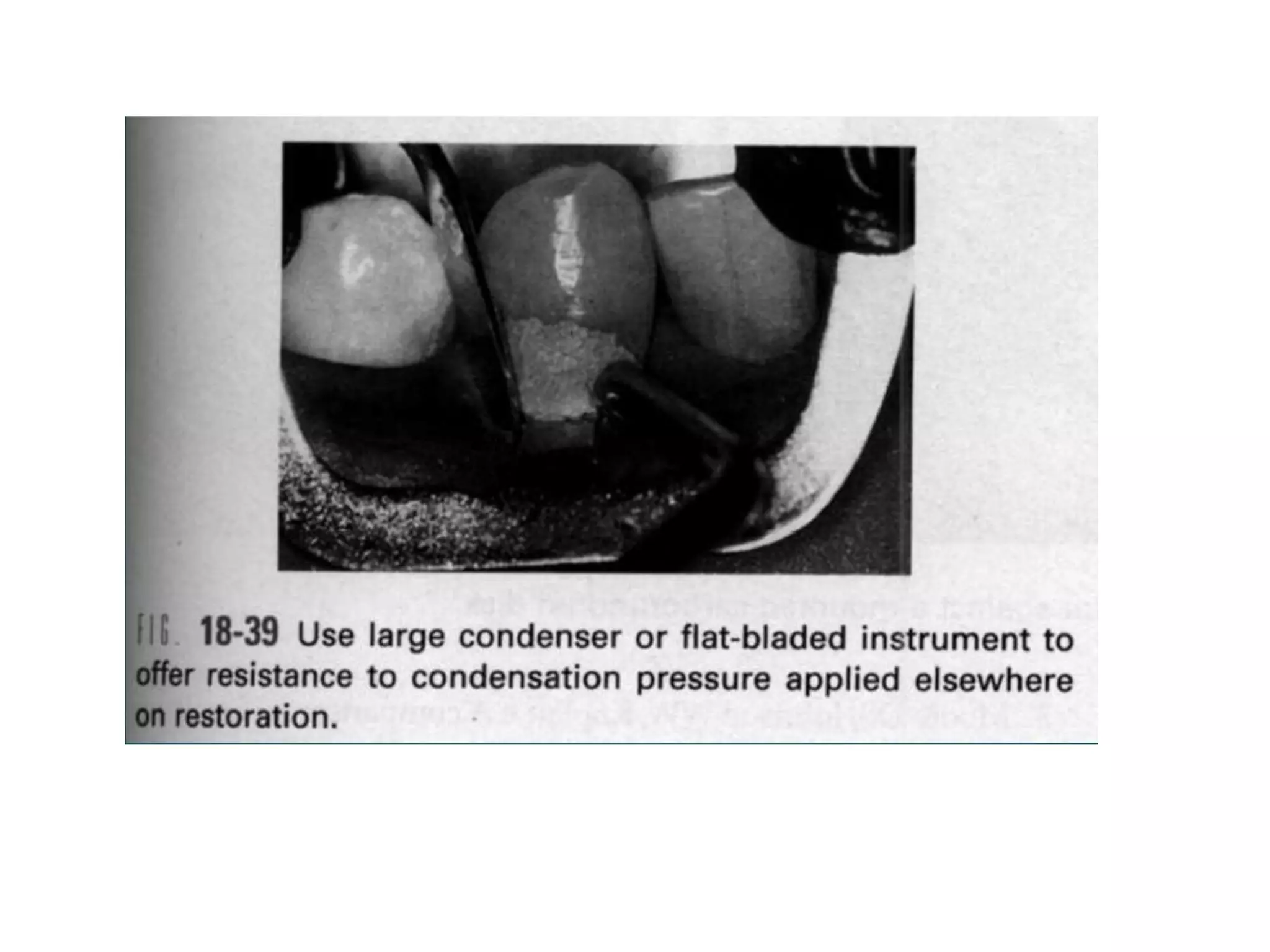 Class V and VI amalgam cavity preparations | PPTX
