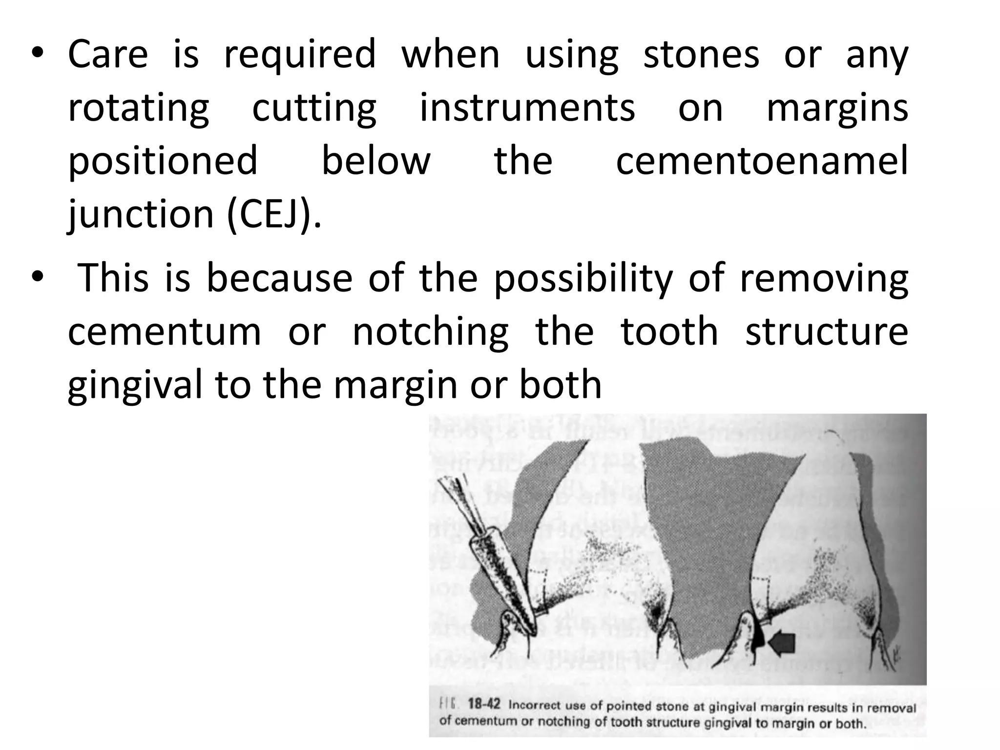 Class V and VI amalgam cavity preparations | PPTX