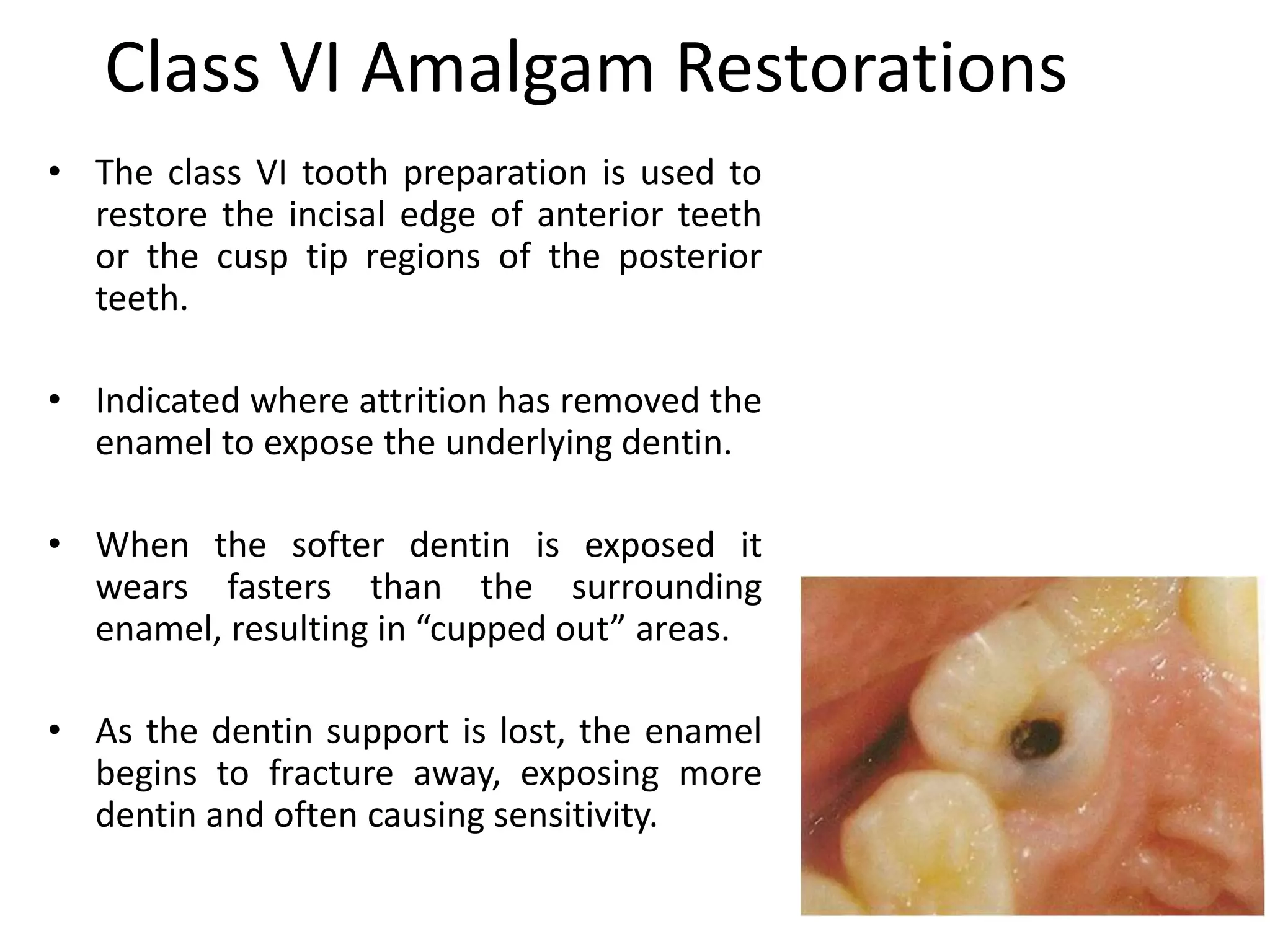 Class V and VI amalgam cavity preparations | PPTX