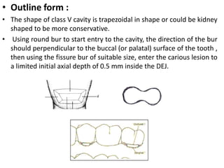 Class V and VI amalgam cavity preparations | PPTX