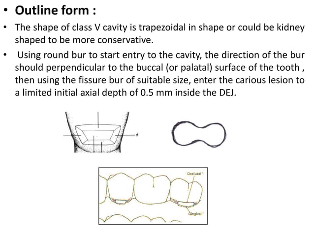 Class V and VI amalgam cavity preparations | PPTX