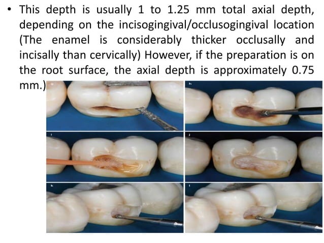 Class V and VI amalgam cavity preparations | PPTX